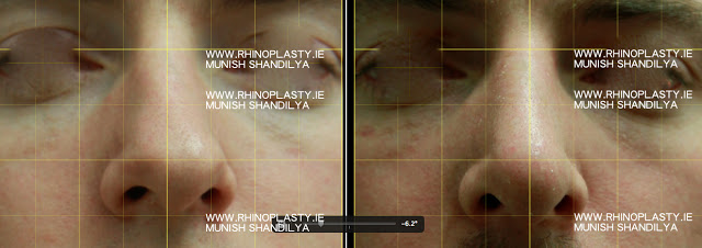 RHINOPLASTY SWELLING AFTER A NOSE SURGERY / RHINOPLASTY – Rhinoplasty Blog