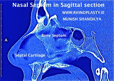 Understanding Septoplasty: Nasal Septum anatomy as seen in the Sagittal ...