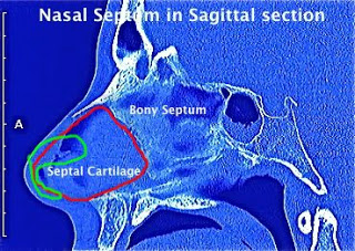 Understanding Septoplasty: Nasal Septum anatomy as seen in the Sagittal ...
