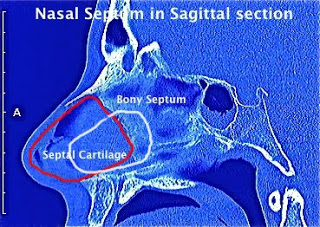 Understanding Septoplasty: Nasal Septum anatomy as seen in the Sagittal ...