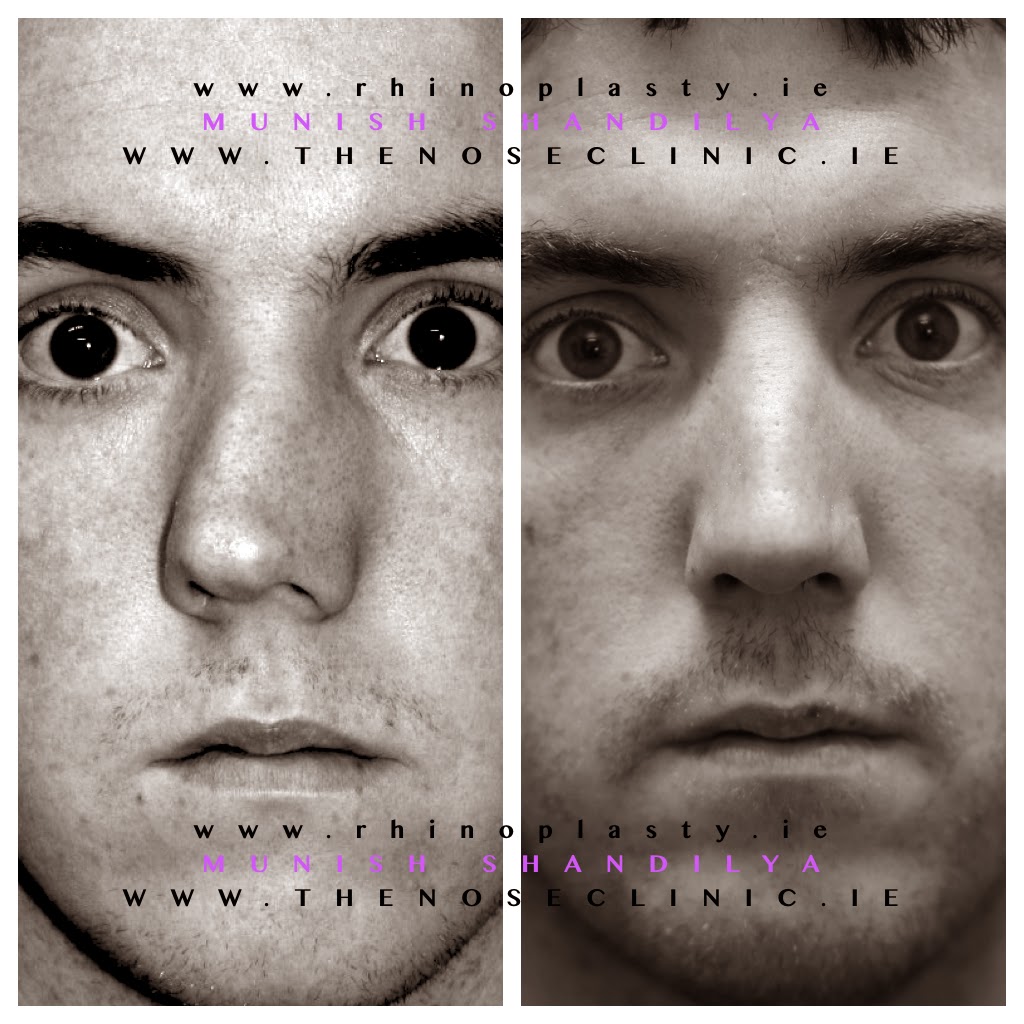 Extracorporeal Septoplasty : 5 years after an In-situ “Extracorporeal ...