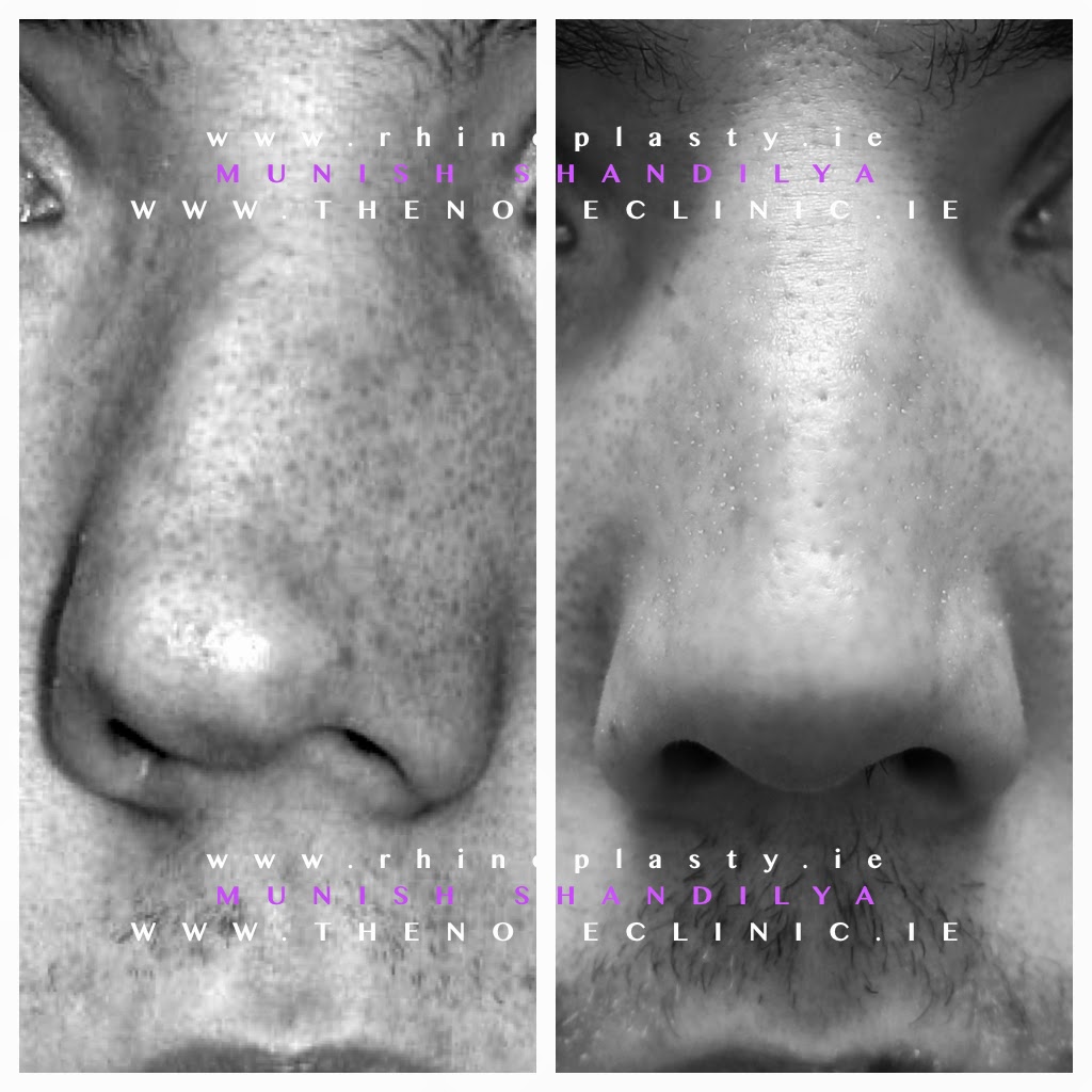 Extracorporeal Septoplasty : 5 years after an In-situ “Extracorporeal ...