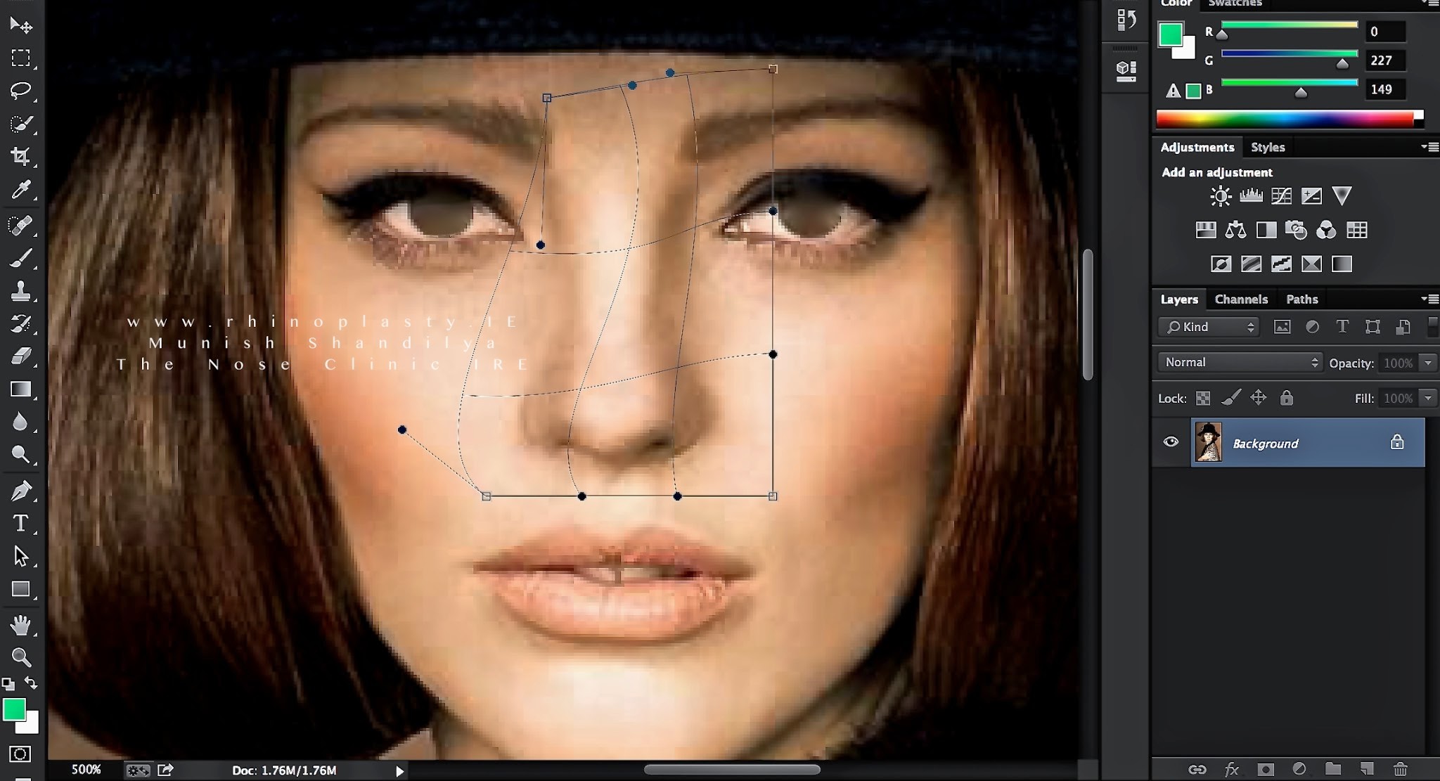 Morphing in Rhinoplasty : Computer Simulation in Rhinoplasty: Digital ...